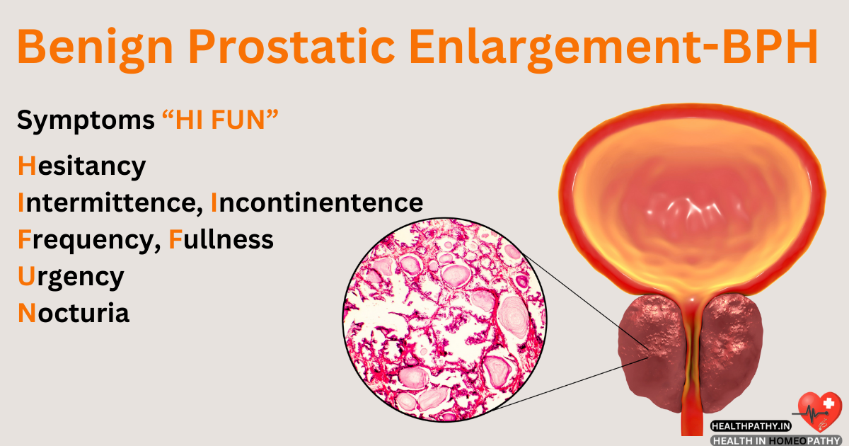 Benign Prostatic Hyperplasia Cures With Scientifically Proven ...